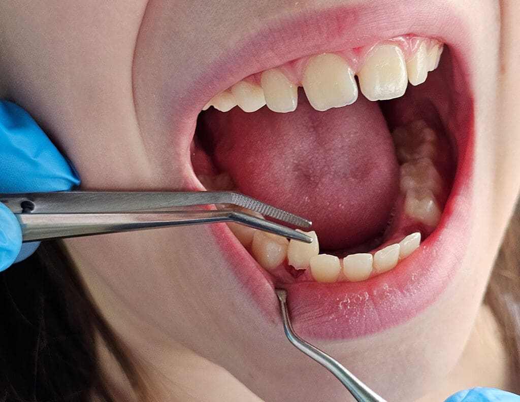 Pediatric tooth extraction | Pediatric dentist in Overland Park KS